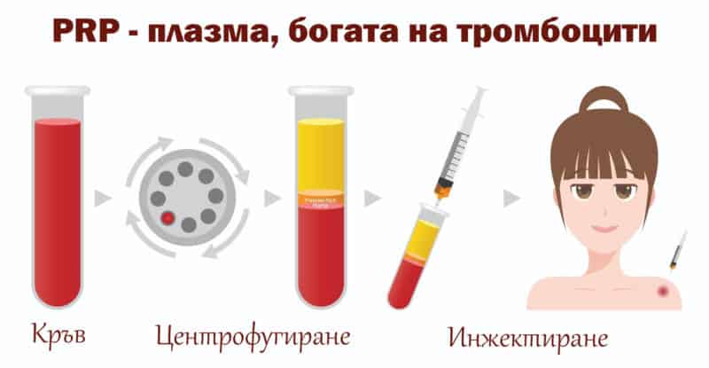 PRP и PRF - плазмотерапия - как регенерира кожата - мнения и цена ...
